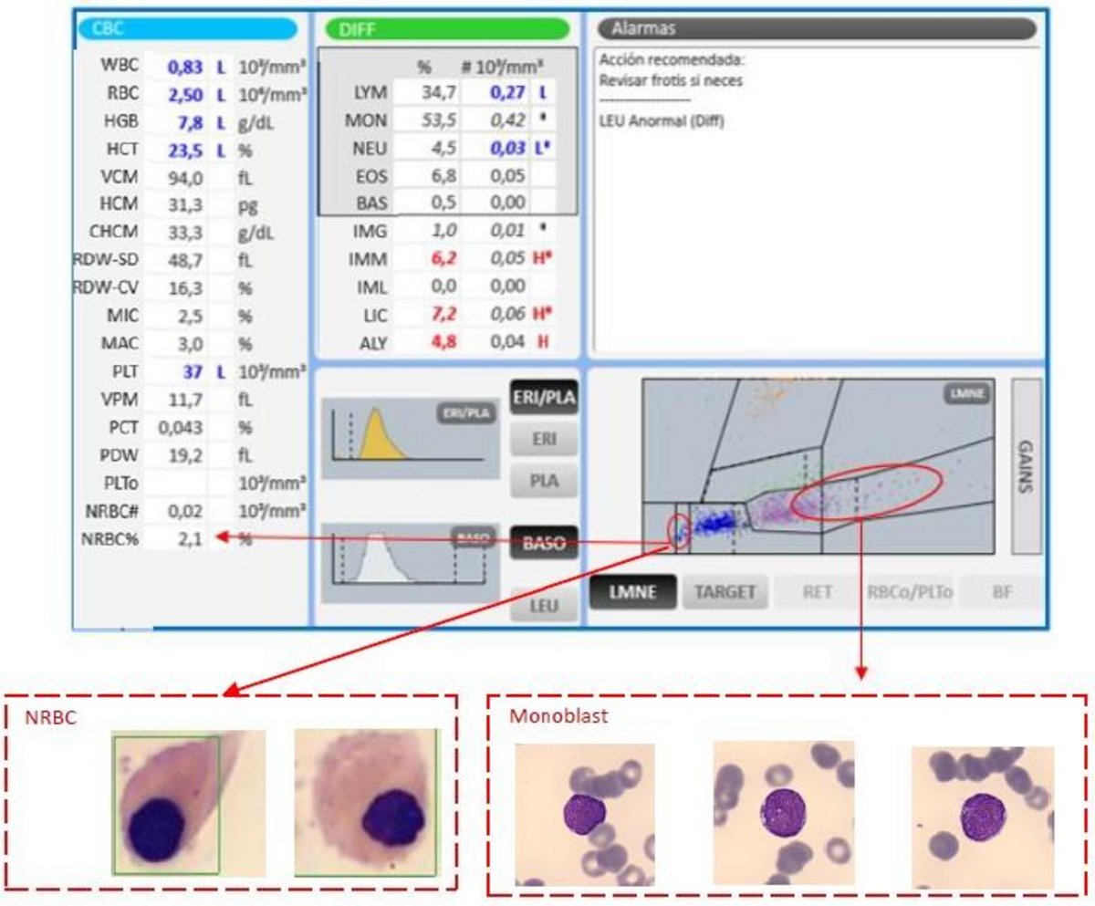 Acute Myeloid Leukemia Clinical Case Horiba