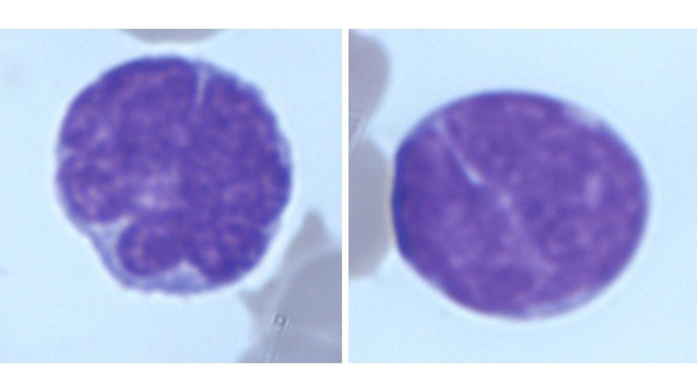 Sepsis, Disseminated Intravascular Coagulation (DIC) | QSP Newsletter