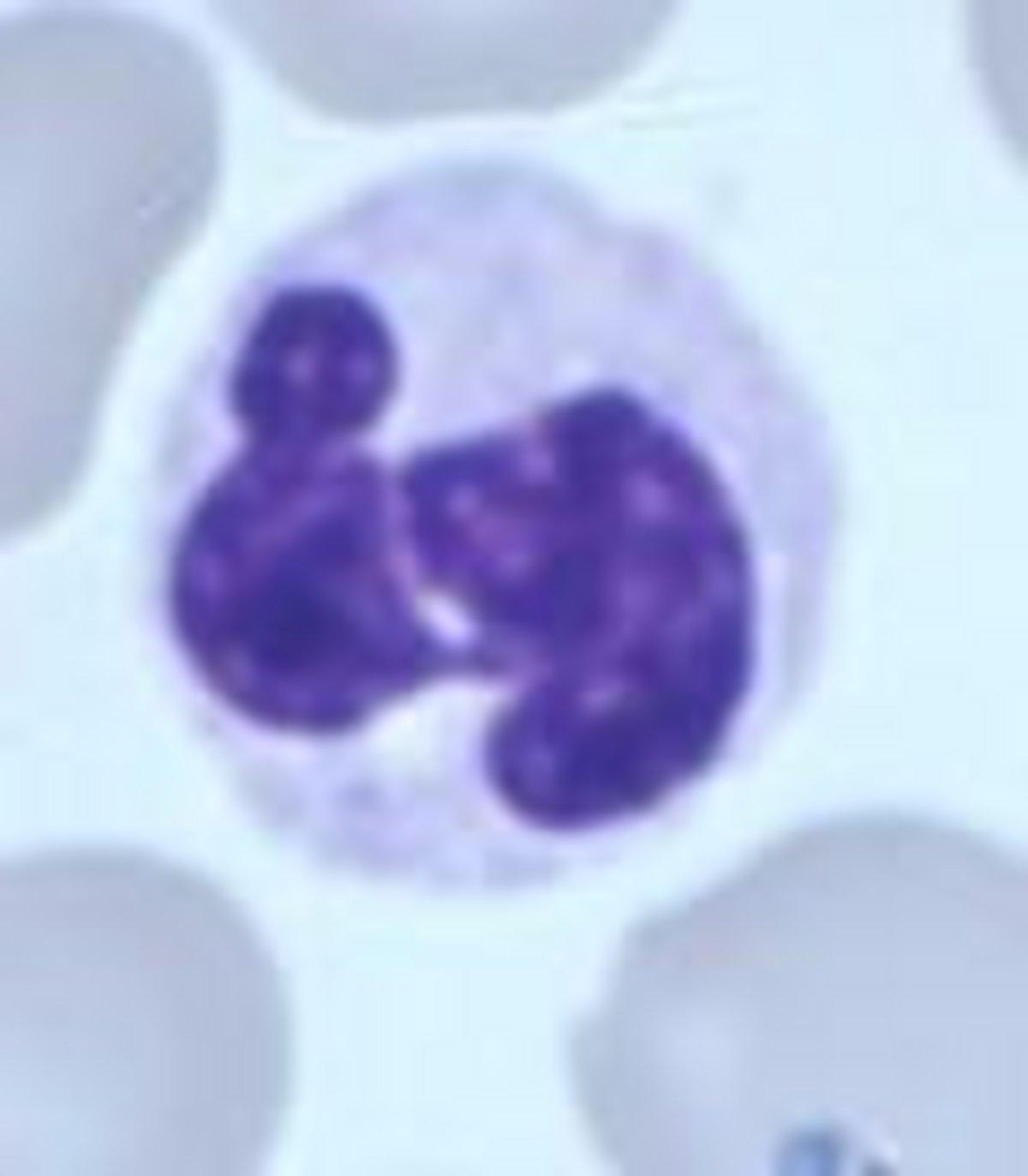 Acute Leukemia - Blood Cell Morphology Newsletter #42
