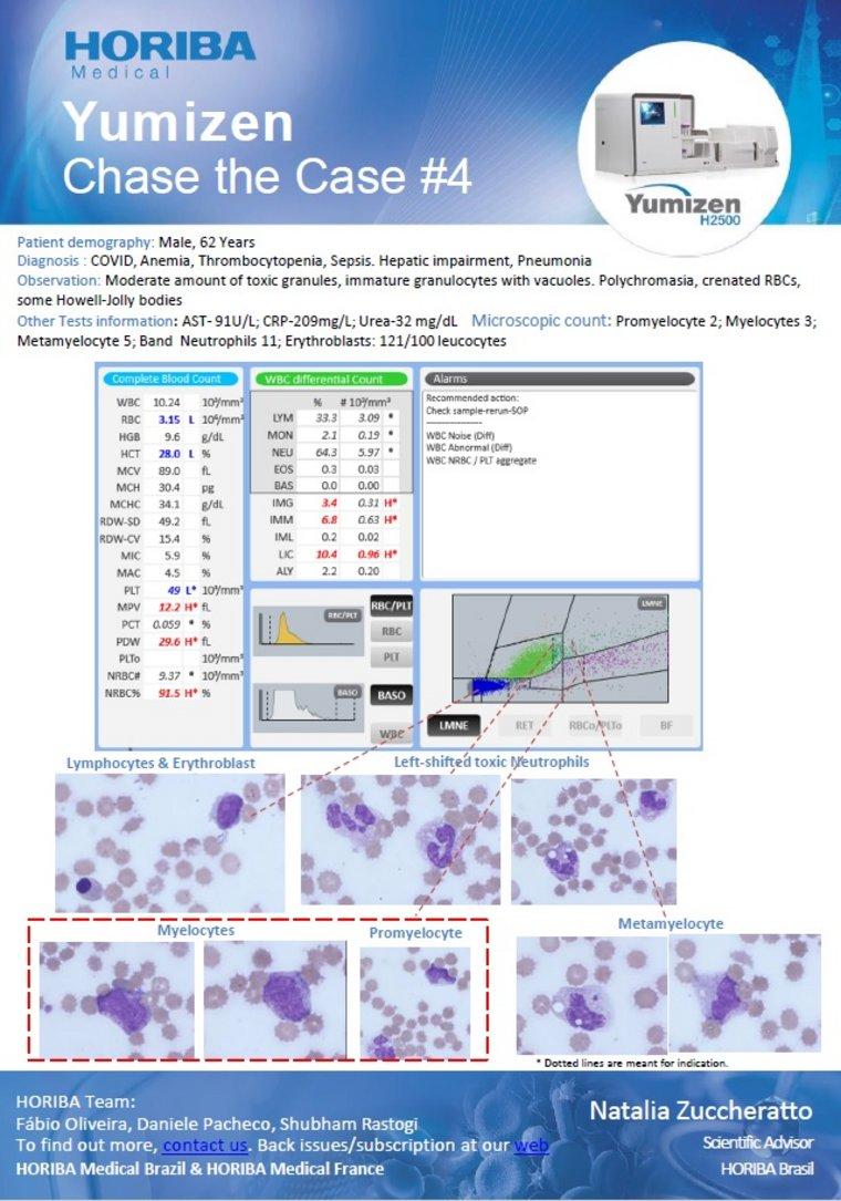 Sepsis and COVID - Clinical Cases of Yumizen H2500 Hematology Analyzers ...