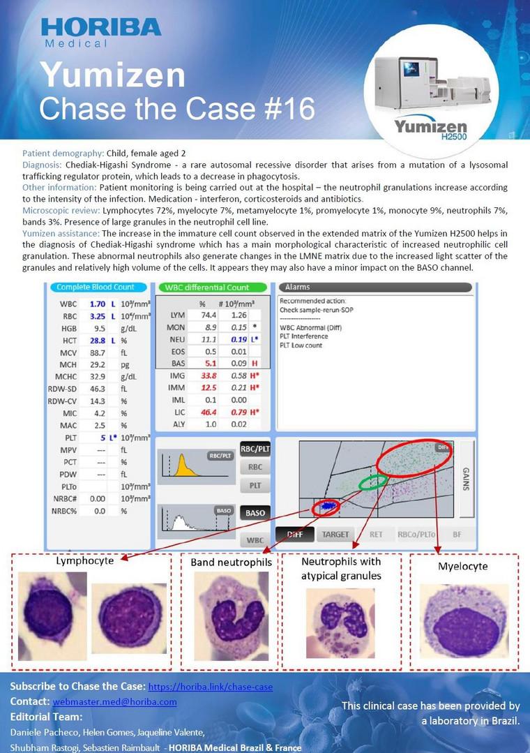 Chediak-Higashi Syndrome - Clinical Cases of Yumizen H2500 Hematology ...