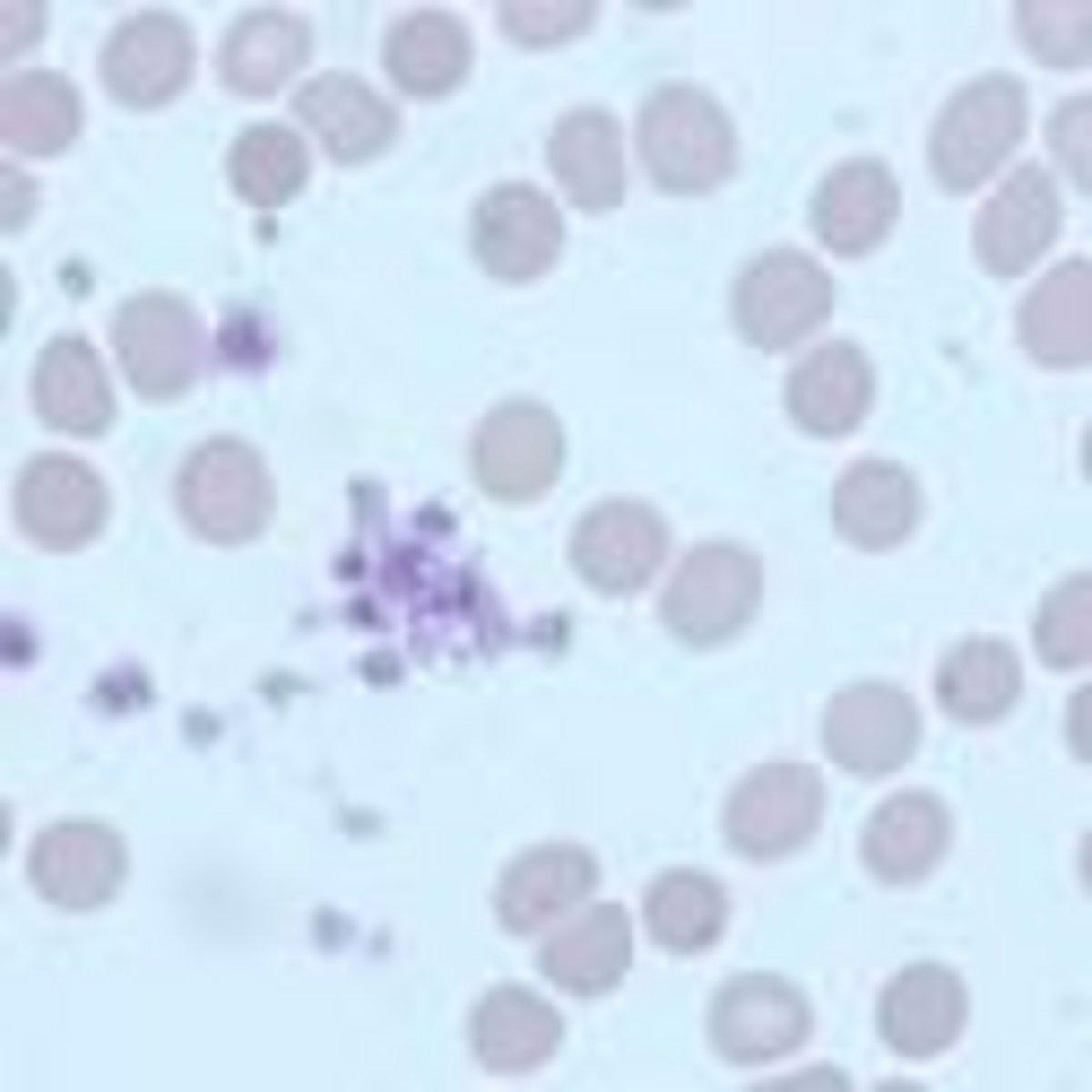 Anemia - QSP Blood Cell Morphology Newsletter #40 (HORIBA Medical)